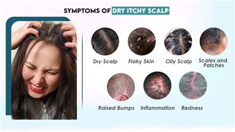 Itchy Scalp Causes And Treatment Scalp Eczema Symptoms Triggers And