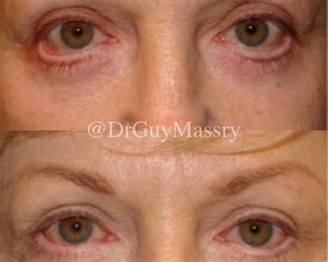 Ectropion And Entropion Repair Dr Guy Massry
