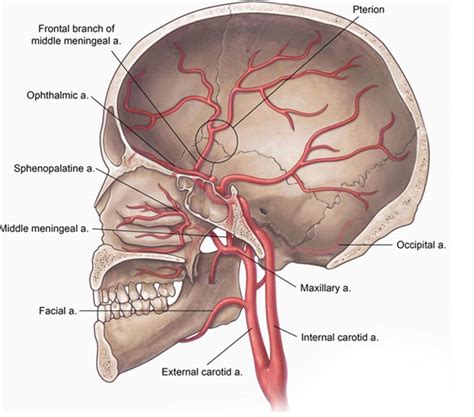 Embolização De Artéria Meningea Média No Hematoma Subdural Neurosky
