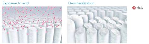 Erosion And Hypersensitivity Treatment Stannous Fluoride Toothpaste Dentalcare