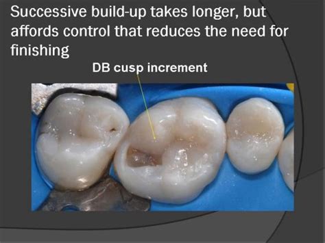 Direct Restorations Posterior Composite Three Techniques For Incremental Placement Of Composite