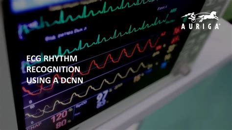 Auriga Ecg Rhythm Recognition Using A Deep Convolutional Neural Network Can Be Improved By