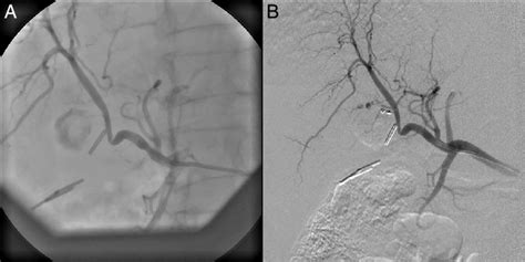 A Angiography Image Demonstrating The Pseudoaneurysm B Download Scientific Diagram
