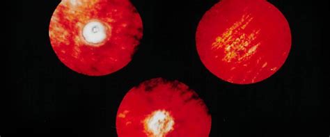 Newyork Presbyterian The Ruby Lasers First Medical Use