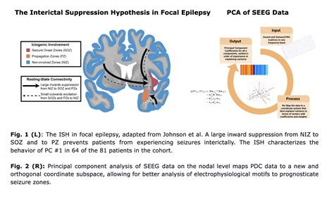 Suppressive Network Motifs Dominate Interictal Seeg Connectivity In