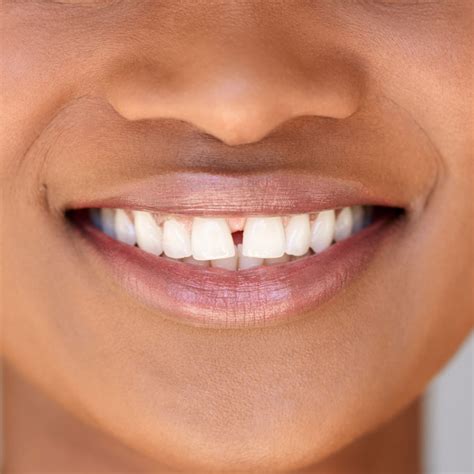 Invisalign And Diastema Gaps In The Front Teeth Huntington Beach Ca