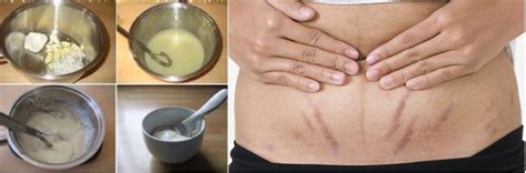 How To Remove Stretch Marks With Home Remedies Fashionforlife1
