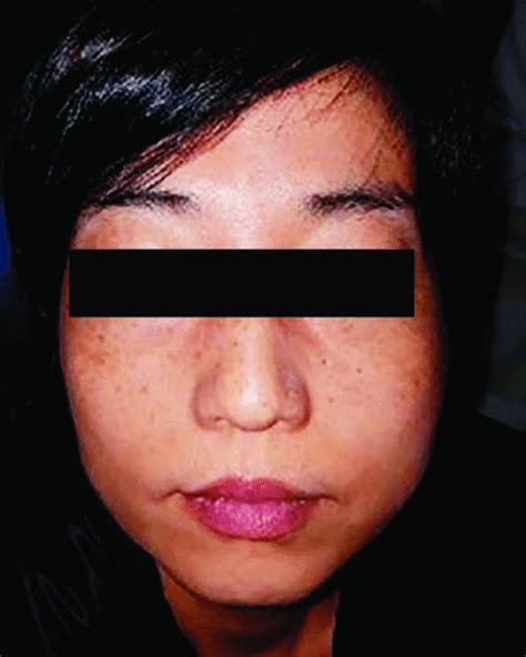 Two Weeks After Embolization Procedure The Left Facial Swelling And