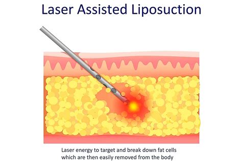 Cryolipolysis Vs Liposuction Which One To Choose To Achieve A Slimmer