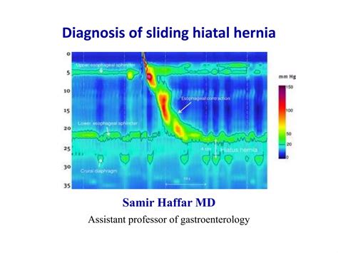 Diagnosis Of Sliding Hiatal Hernia Pptx