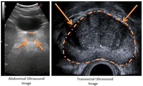 Enlarged Prostate Ultrasound Report