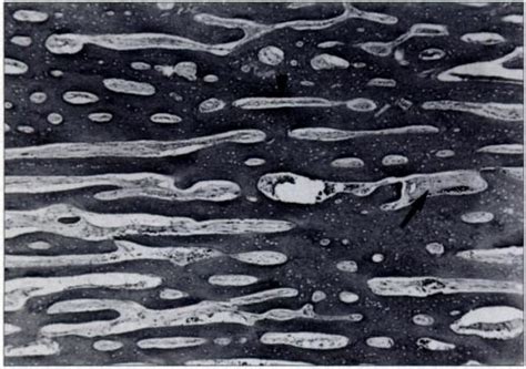 Histologic Section Reveals Thickened Cortex With Longitudinally