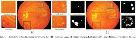 Figure From Segmentation Of Retinal Lesions In Fundus Images A Patch Based Approach Using