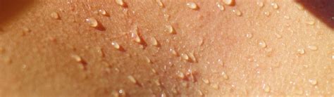 The Different Types Of Hyperhidrosis Dermadry