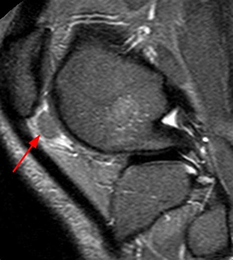 Popliteal Lymph Nodes Mri