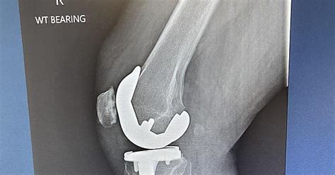 Had My Knee Replaced In April Its A Neural Net Processor A Learning