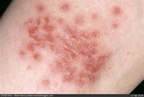 Stock Image Dermatology Infected Eczema A Cluster Of Red Weeping