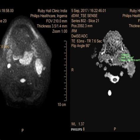 Adiffusion Restriction Present On Diffusion Weighted Images B 600 Download Scientific