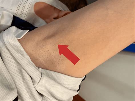 Axillary Web Syndrome Axillary Web Syndrome What Is Cording And How To