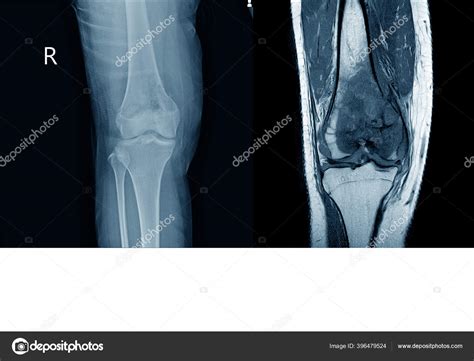 Osteosarcoma Knee Mri