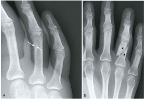 Recognizing Fractures And Dislocations Flashcards Quizlet