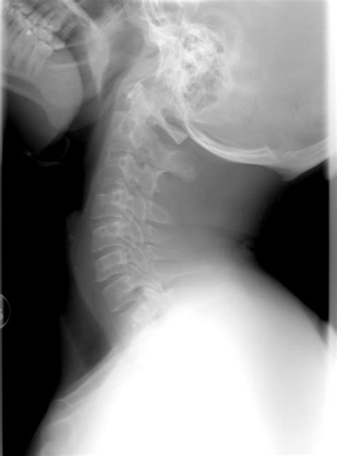 목디스크 증상 치료방법 개선법