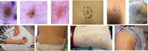 Lesion Detection Examples Top Dermoscopy Images Bottom Smartphone Download Scientific