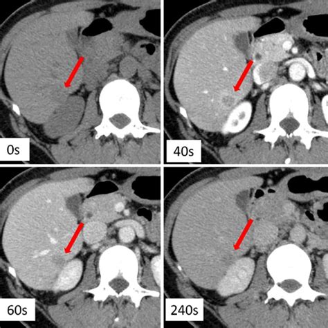 Figure2multidetector Row Computed Tomography Ct Findings Unenhanced Download Scientific