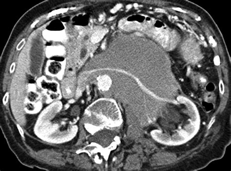 Radiology Of The Retroperitoneum Case Based Review Ajr