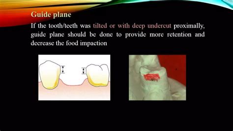 Removable Partial Denture Rpd Design Part 2 Pptx Oral Care Personal Care
