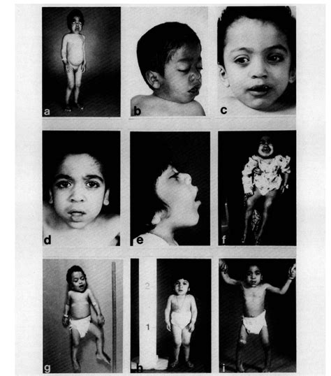 Figure 1 From Saudi Variant Of Multiple Sulfatase Deficiency Semantic Scholar