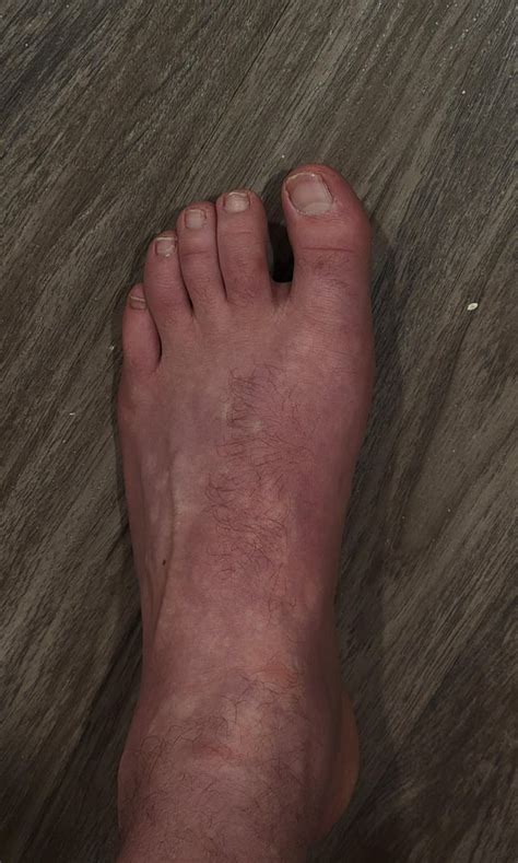 Pots And Blood Pooling Part Of Venous Insufficiency Or Something Else