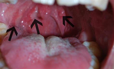 Cancer Bumps On Back Of Tongue