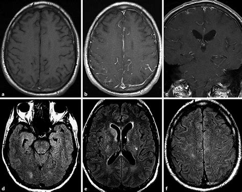 Abnormal Brain Mri With Contrast