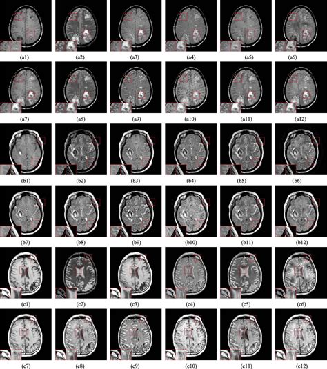 Figure 7 From Medical Image Fusion With Parameter Adaptive Pulse