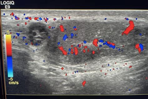 Torsed Testicular Appendix R Radiology