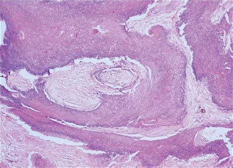 Histological Section Showing Evolution Of Basaloid Cells Into Shadow Download Scientific
