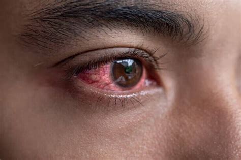 Most Common Restasis Side Effects Amplify Eyecare