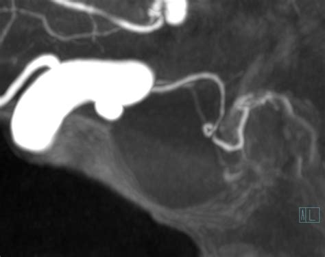 Superior Hypophyseal Artery