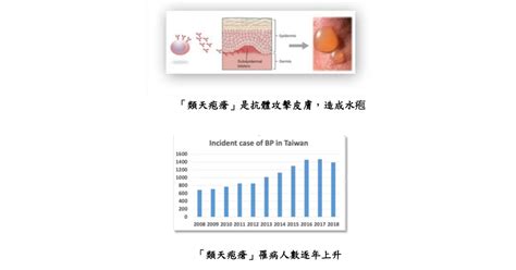 民報 Taiwan People News 類天疱瘡真要命糖尿病口服類固醇用藥風險倍增