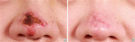 Asc Based Cell Therapy For A Case Of Acute Skin Necrosis In The Nose