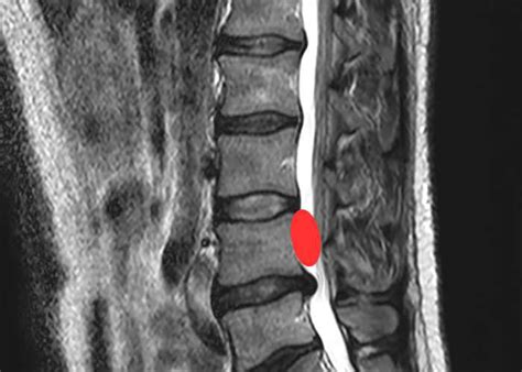 Spinal Cord Ependymoma Spine Cancer Specialist St Louis St