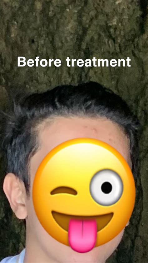 Diffuse Hair Loss After Acne Treatment Rtelogeneffluvium