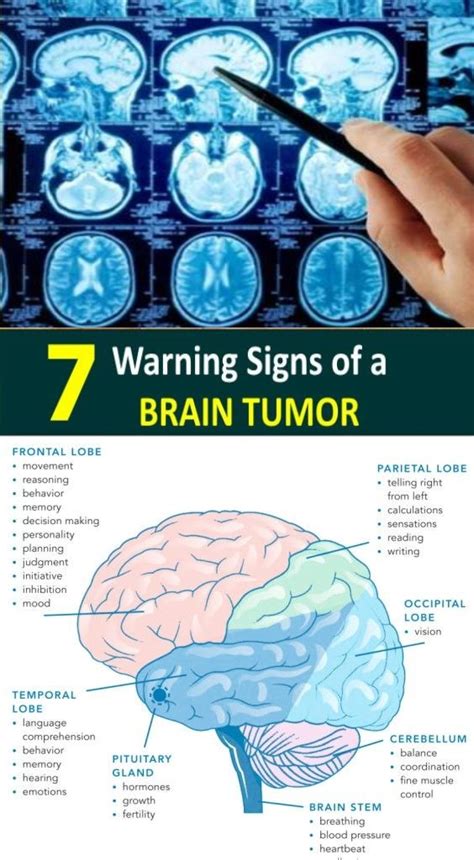 7 Warning Signs Of A Brain Tumor Healthy Lifestyle