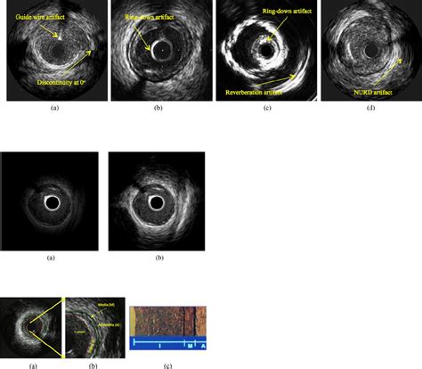 A State Of The Art Review On Segmentation Algorithms In Intravascular Ultrasound Ivus Images