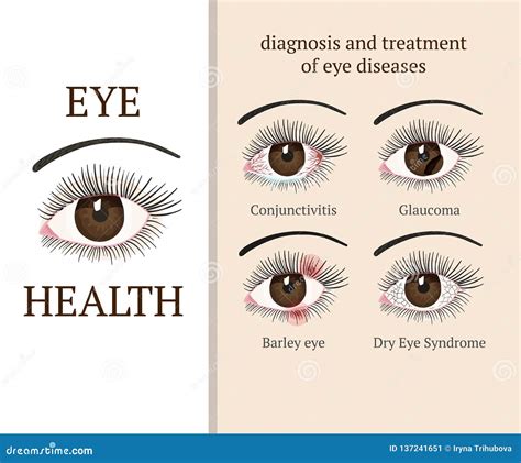 Most Common Eye Problems Stock Vector Illustration Of Conjunctiva