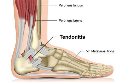 The 8 Best Treatments For Tendonitis In The Foot Cincinnati Foot