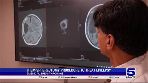 Medical Breakthroughs Hemispherectomy Procedure To Treat Epilepsy