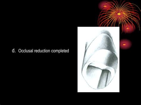 Partial Coverage Restorations Pdf