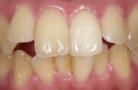 神経をとった濃い歯を白くしたい 札幌市白石区の歯医者「医療法人東札幌 三輪デンタルクリニック」